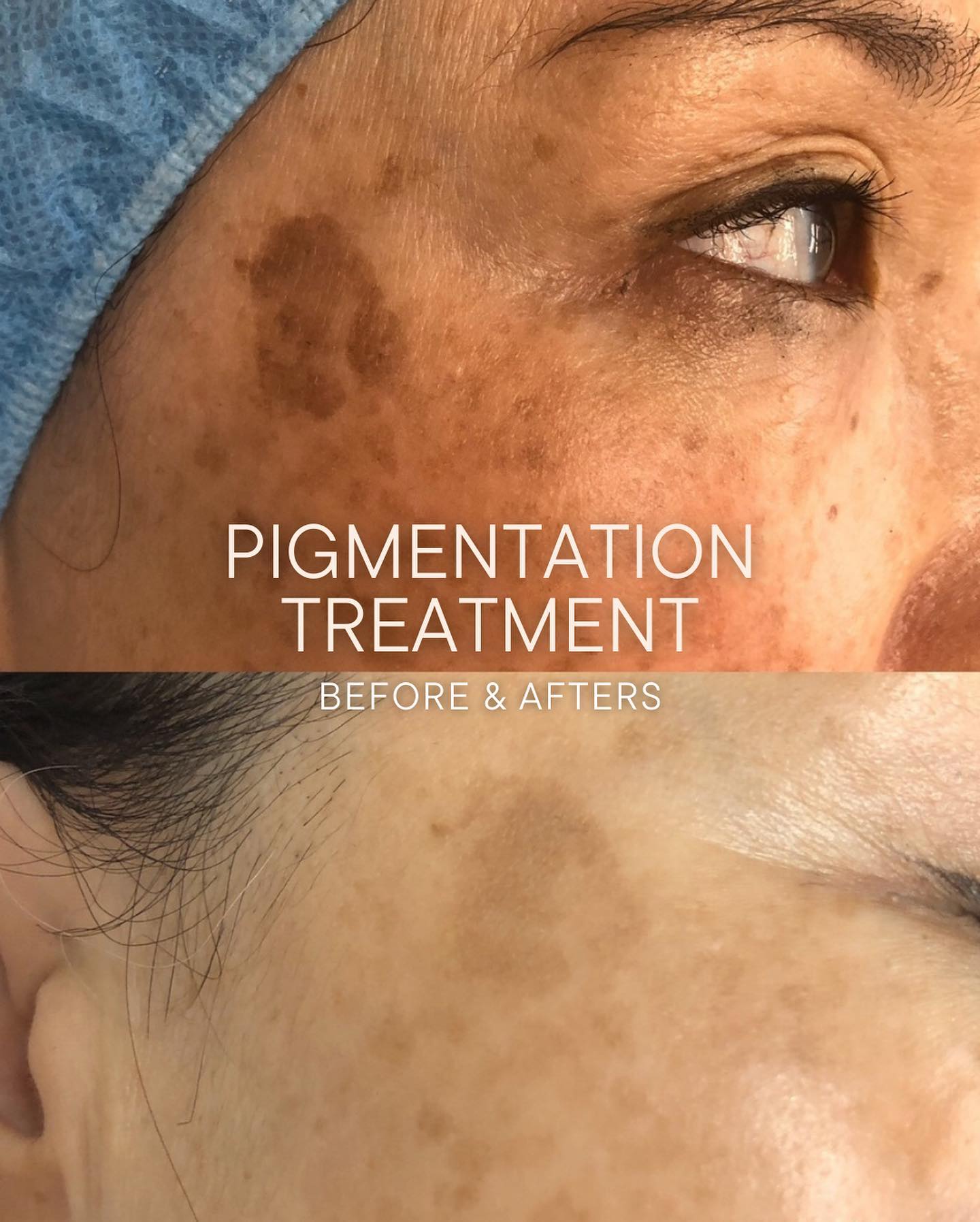 Laser Hair Removal NYC | Manhattan Laser Clinic